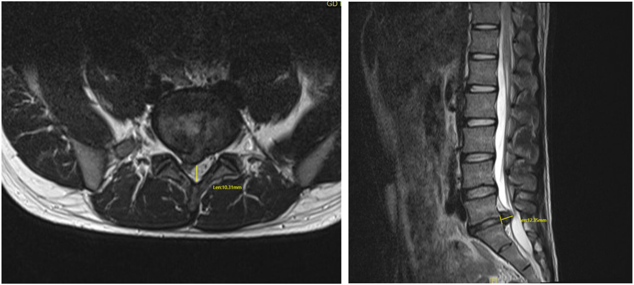 Disc Bulge – Q Spine