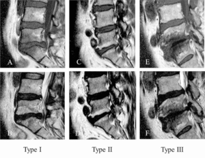Modic Changes – Q Spine