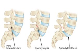 Pars Fracture (Spondylolysis) – Q Spine