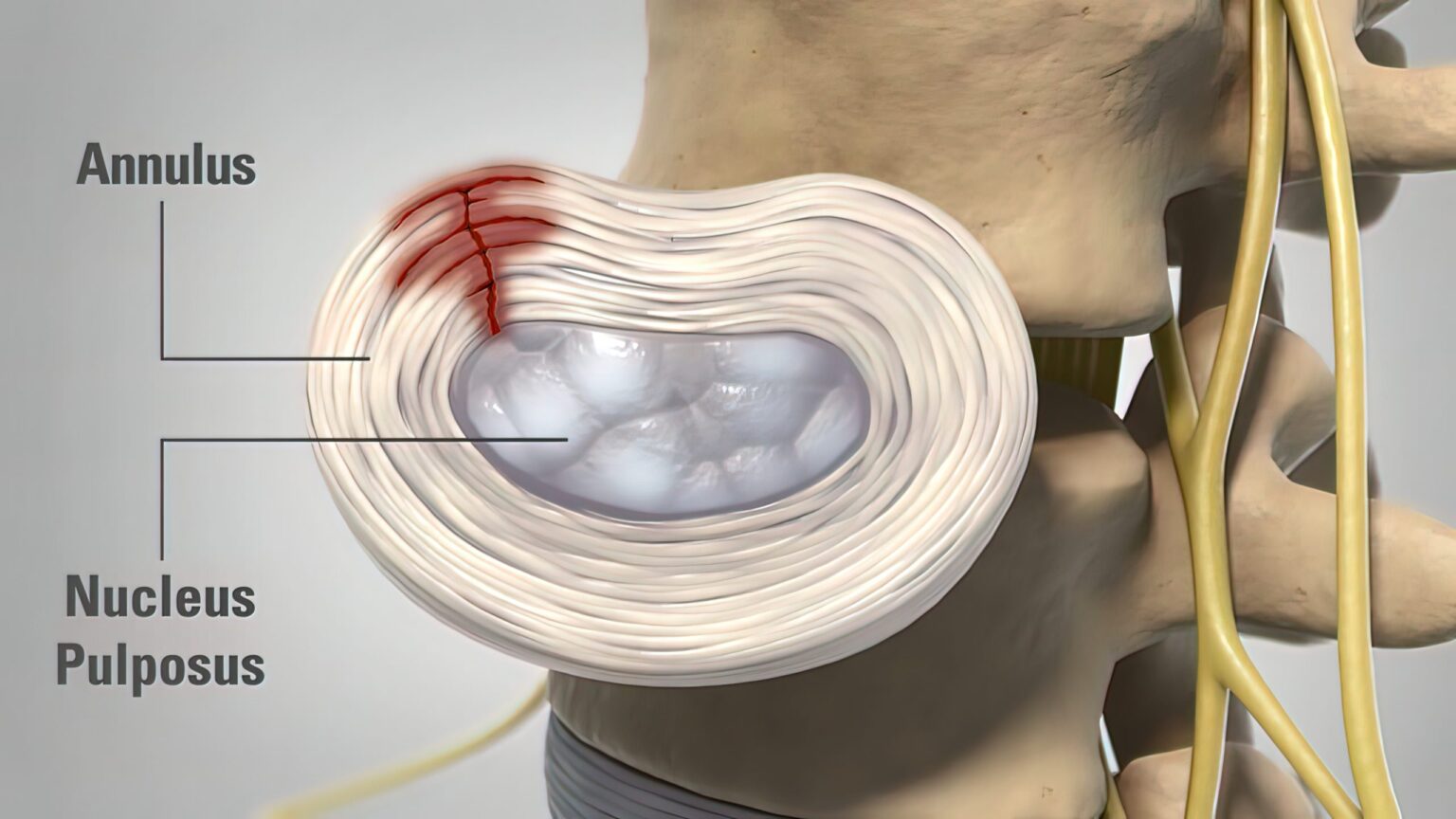 Annular Tears – Q Spine