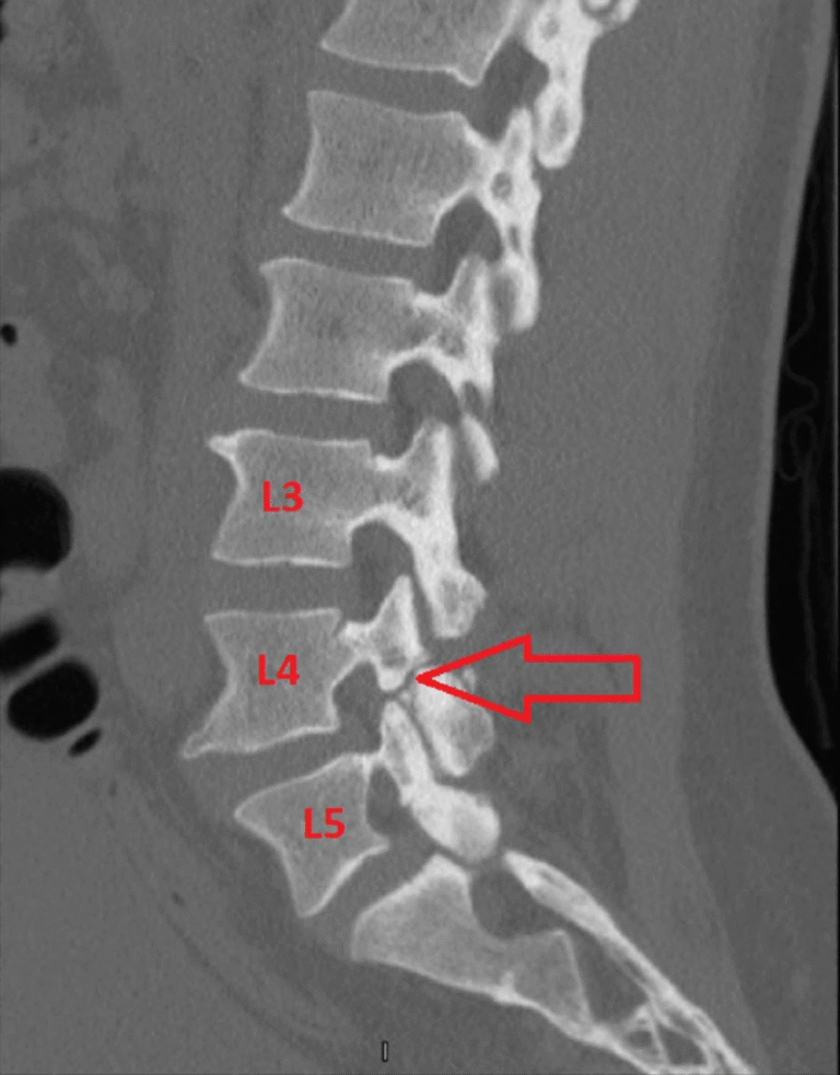 Pars Fracture (Spondylolysis) – Q Spine