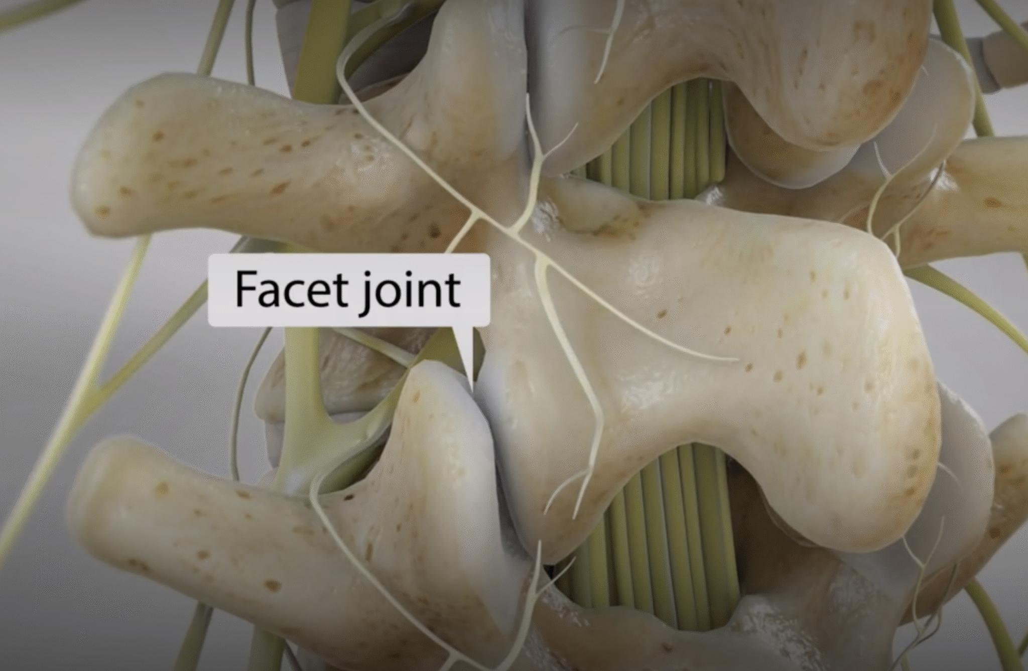Facet joint pain – Q Spine